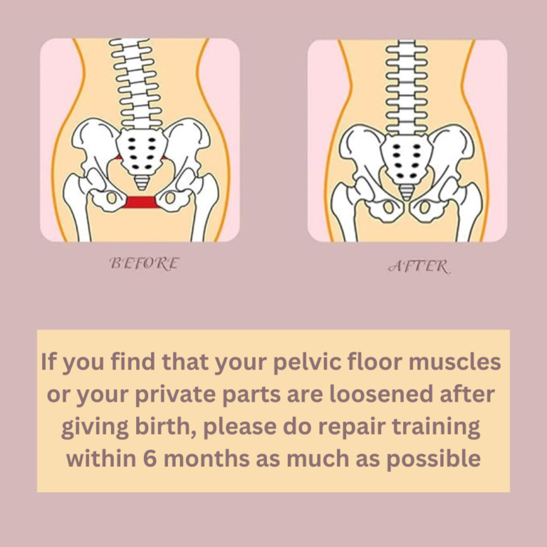 B-Arm Pelvic Floor Muscle Trainer with Screw – Pink | Targeted Leg ...